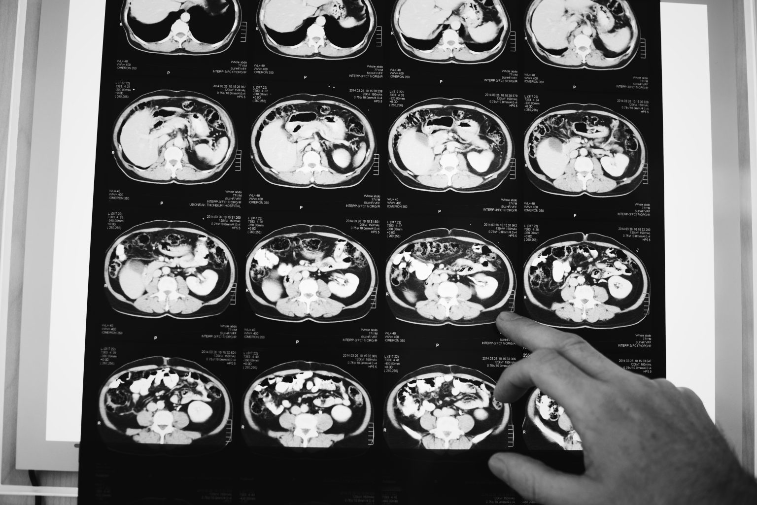 ¿Qué es un TAC? Explorando la Tomografía Computarizada - NeuroAiD™