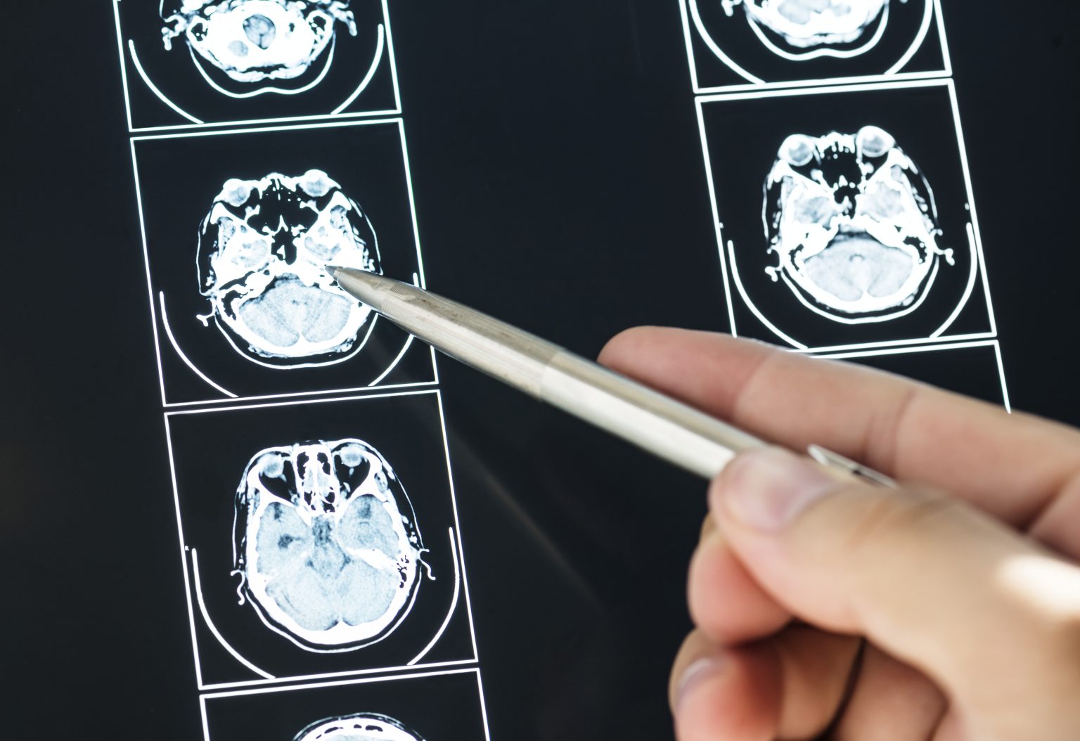 Ataxia Cerebelosa: Síntomas, Causas y Tratamientos - NeuroAiD™