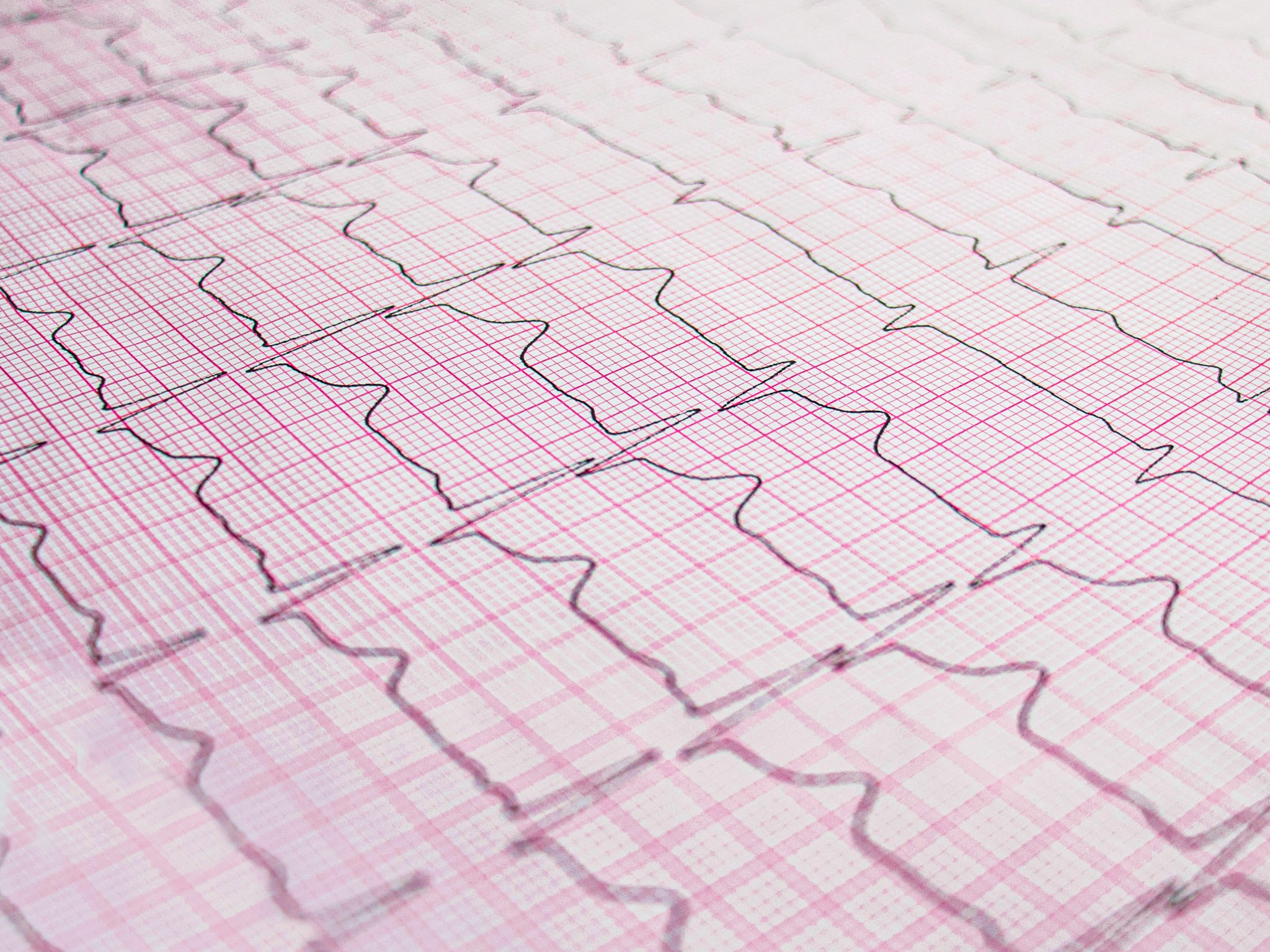 Electrocardiograma y ACV: la influencia de la hipertensión - NeuroAiD™