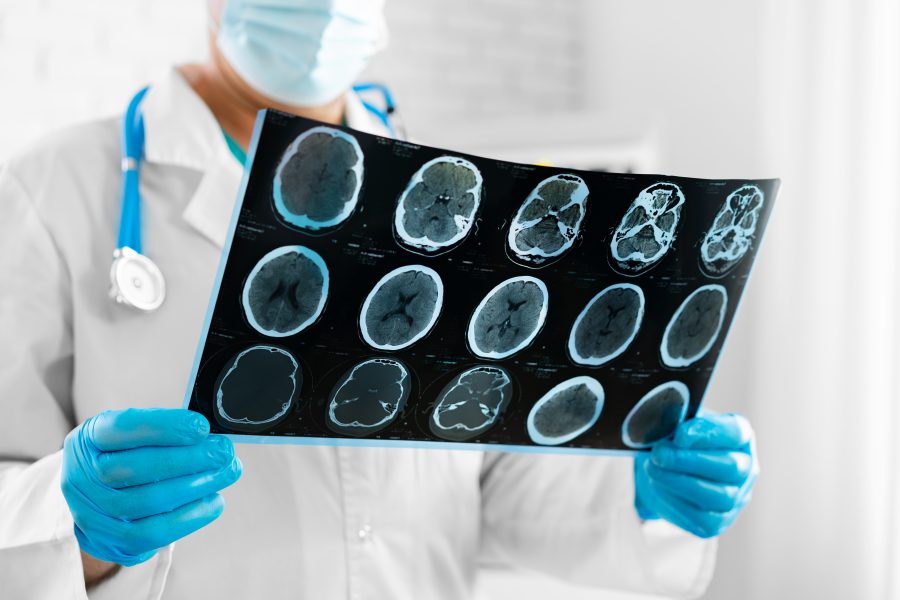 En que consiste un accidente cerebrovascular isquémico