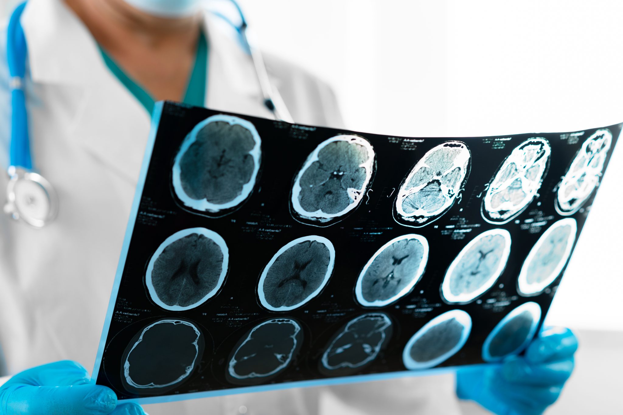 Subdural Hygroma: Causes, Symptoms, and Treatment - NeuroAiD™