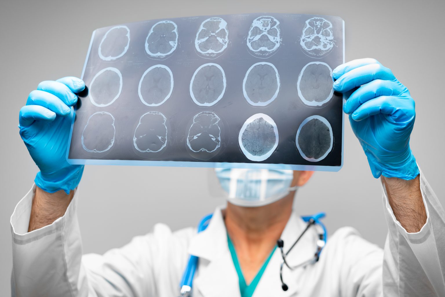 Phases of a stroke and its impact - NeuroAiD™