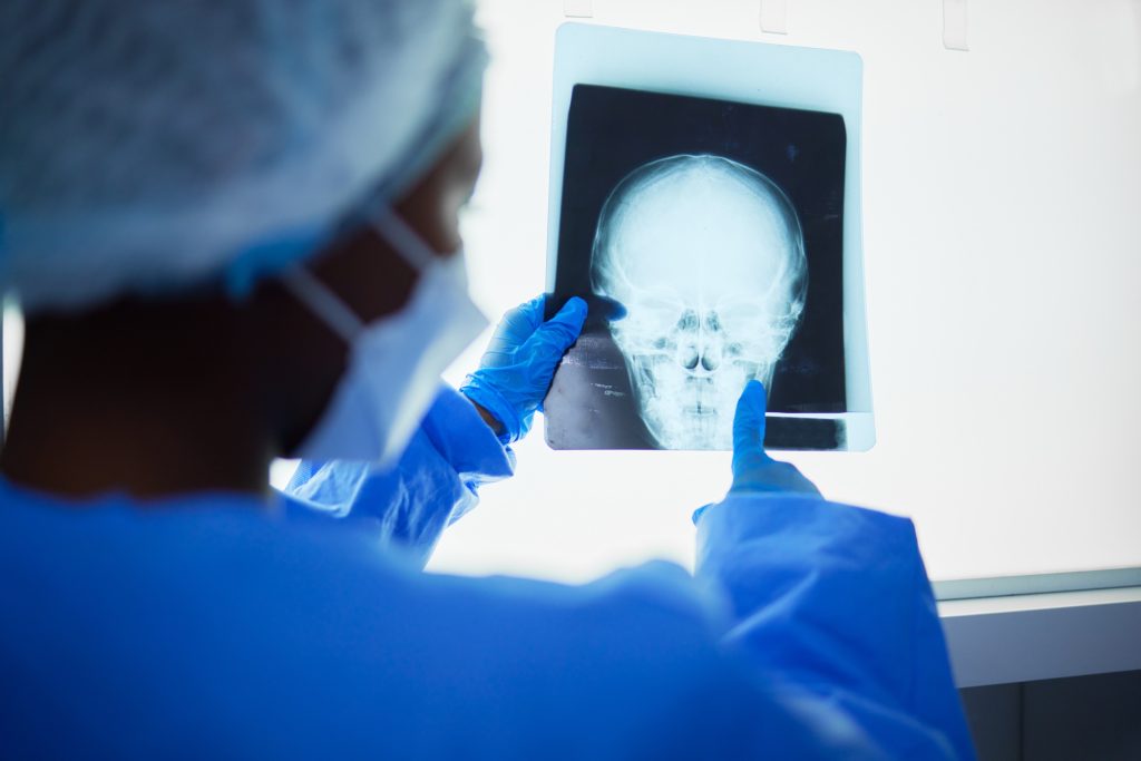 Decompressive hemicraniectomy: a life-saving option after a stroke ...